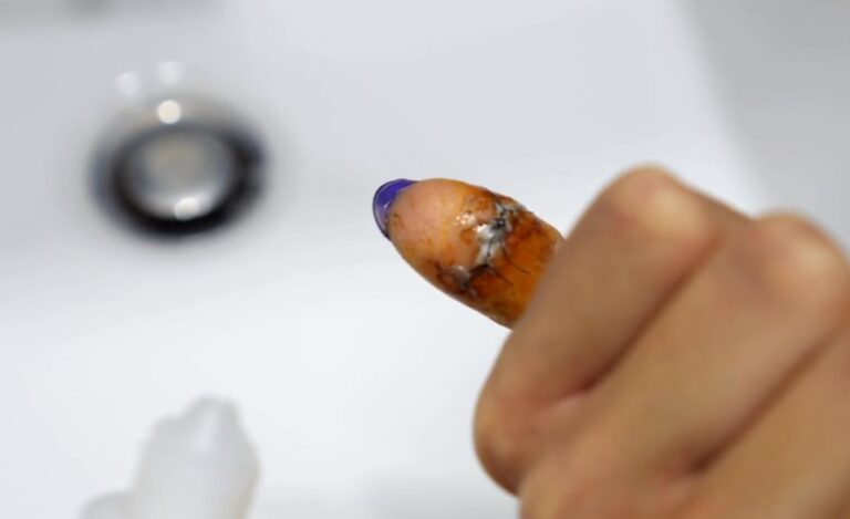 8 Signs You Have an Infected Wound: Warning Signals