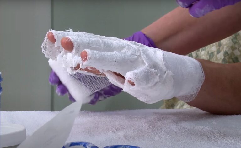 10 Mistakes to Avoid with Burn Wounds: Do's and Don'ts You Need to Know