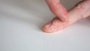 Understanding Wound Healing and the Itching Dilemma: The Unseen Journey