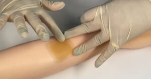 Your Guide to Hydrocolloid Dressings: Effective Wound Care