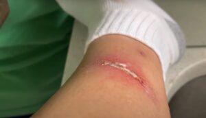 Know the Colors that Indicate Wound Healing Stages - What It Tells ...